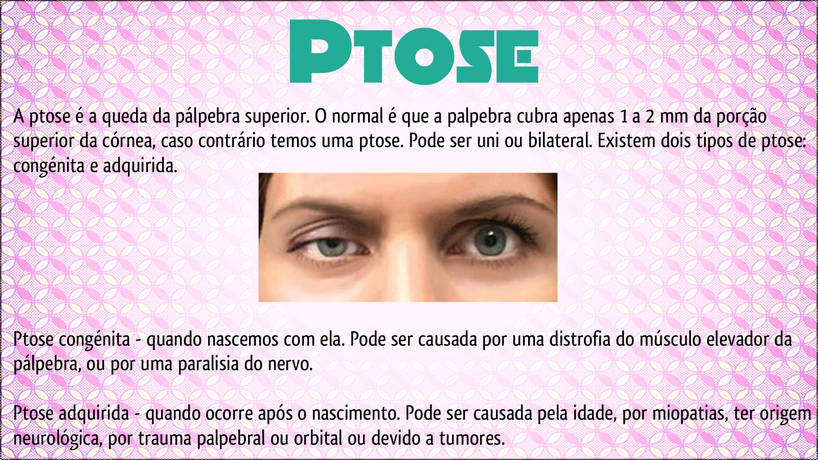Ptose – Grupo FlipÓptica