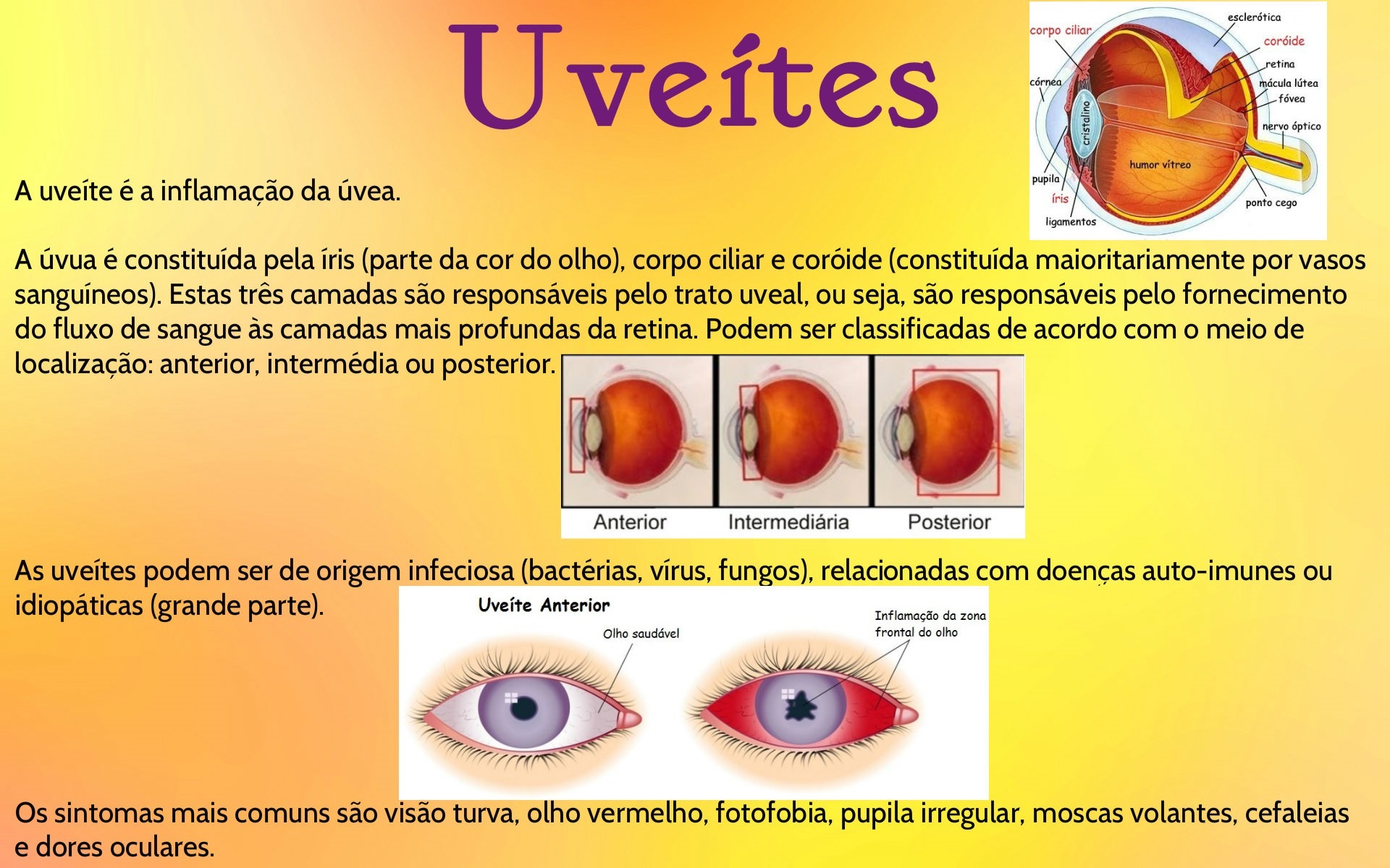 Uveítes – Grupo FlipÓptica